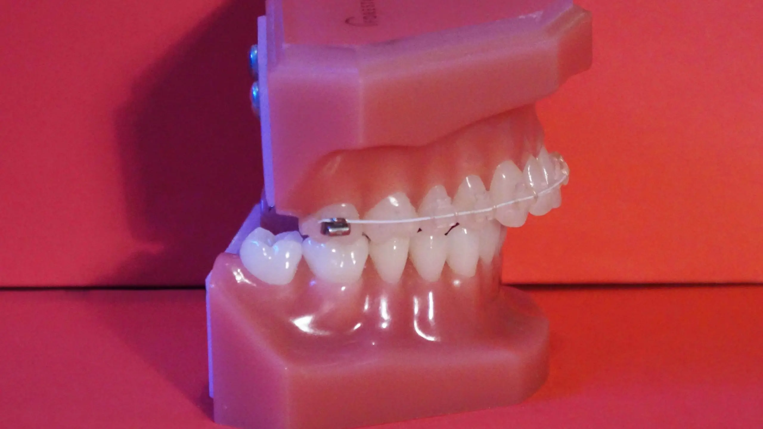 Ortodoncia Para Dientes Hacia Adelante: Cómo Funciona Y Qué Resultados ...