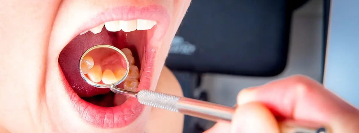 Dientes En El Paladar: ¿Qué Son Y Cómo Se Tratan? | Ortodoncia Junin