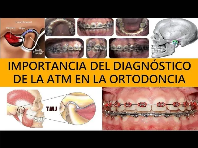 Problemas De Atm Por Ortodóncia: Causas, Síntomas Y Tratamientos ...