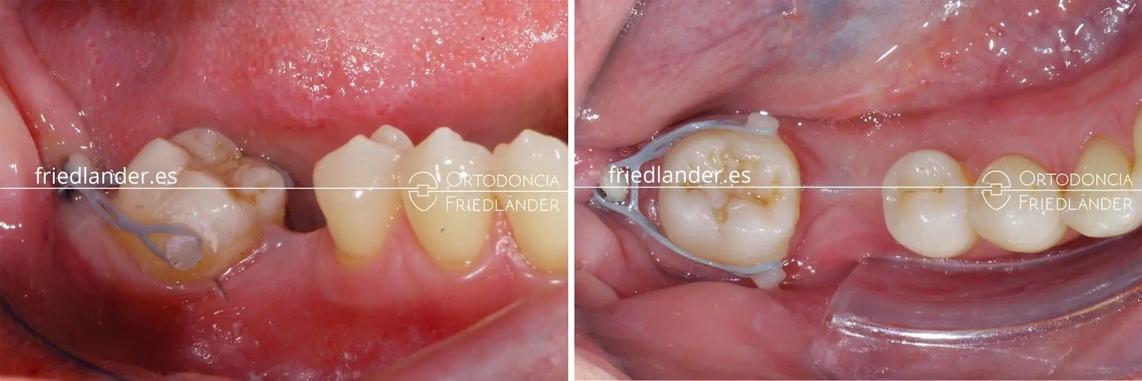 Ortodoncia Con Dientes Faltantes: Todo Lo Que Necesitas Saber ...